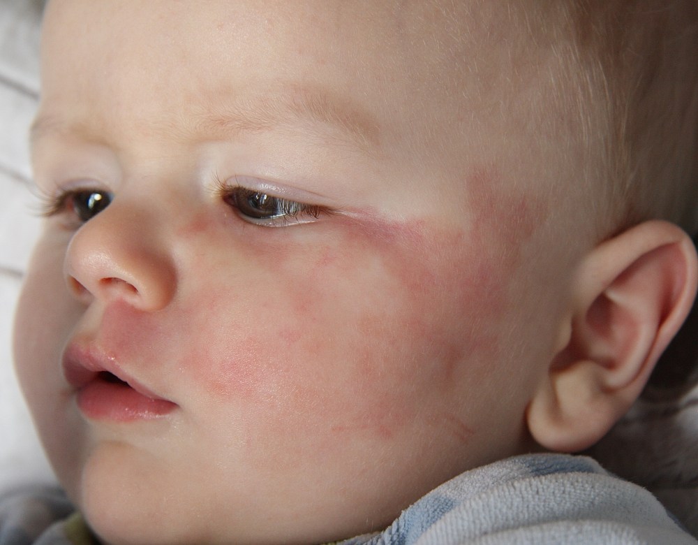 Angiome plan du bébé , bis | journal d'une naturopathe