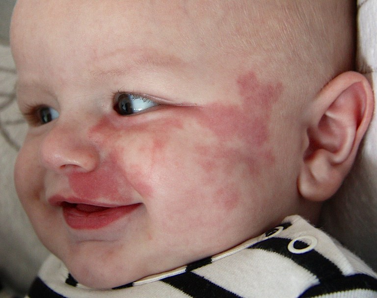 Angiome plan du bébé , bis | journal d'une naturopathe