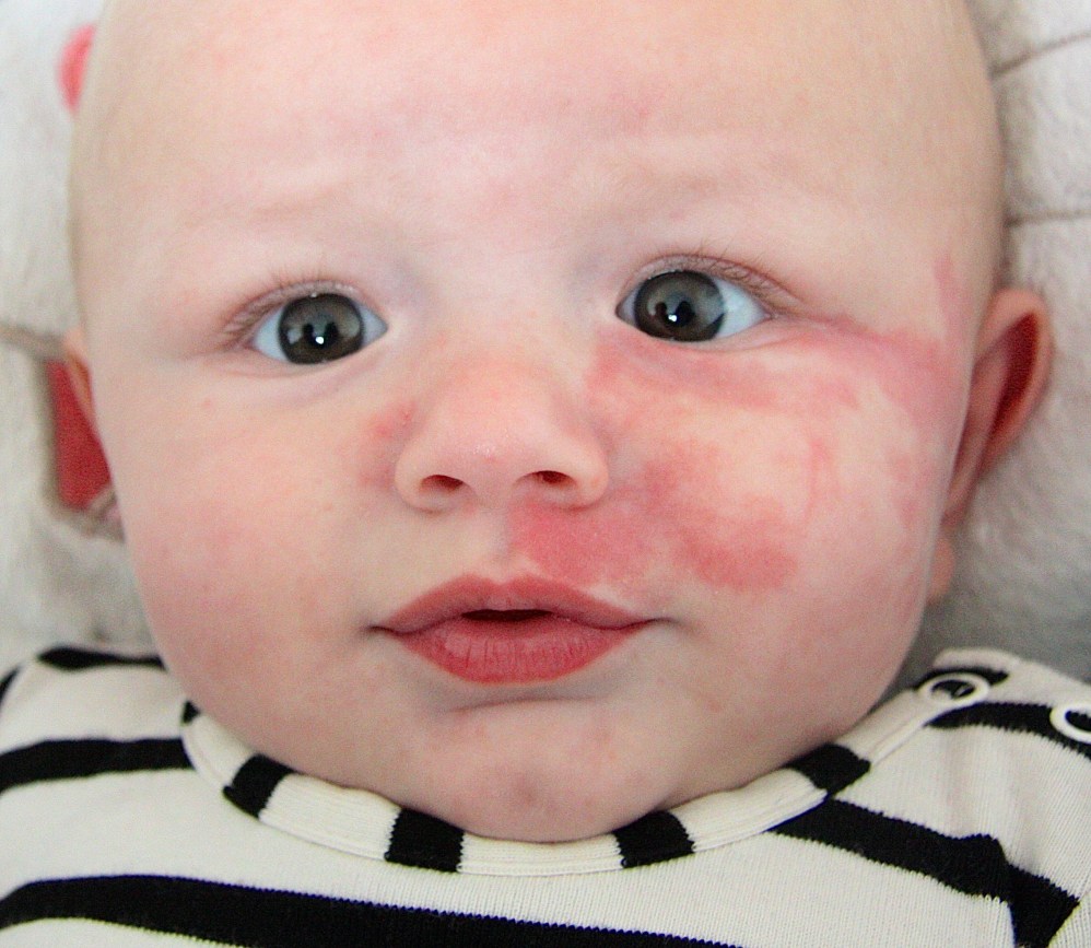 Angiome plan du bébé , bis | journal d'une naturopathe