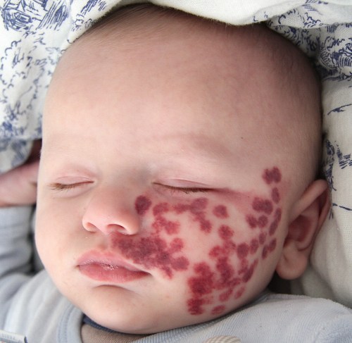 Angiome plan du bébé , bis | journal d'une naturopathe