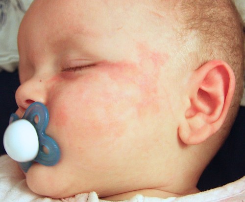 Angiome plan du bébé , bis | journal d'une naturopathe